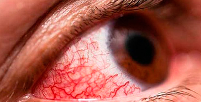 Permanece vigente alerta ante casos de conjuntivitis hemorrágica